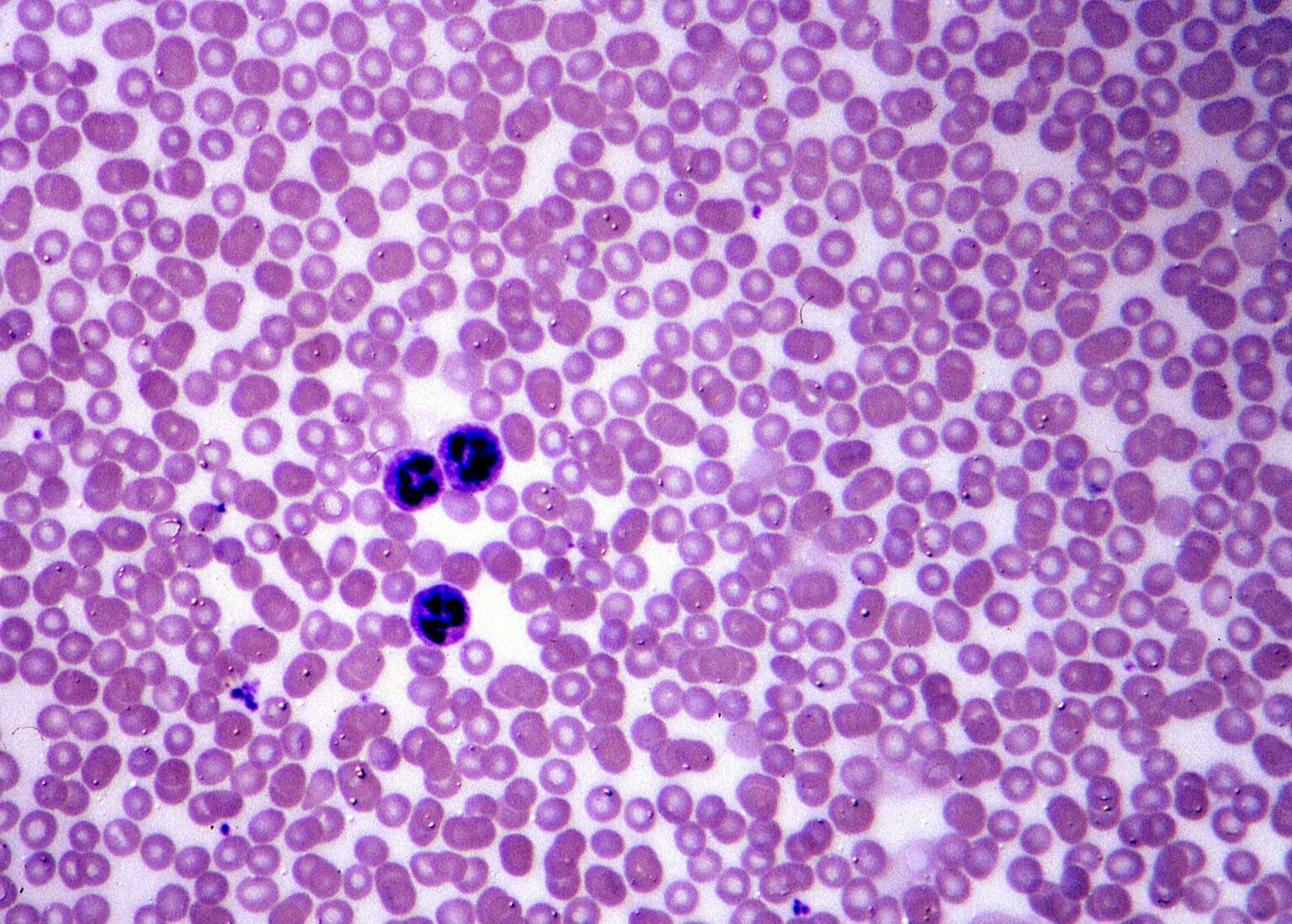 Leukocyty i bakterie w moczu: przyczyny, badania i terapie – Zdrowy ...