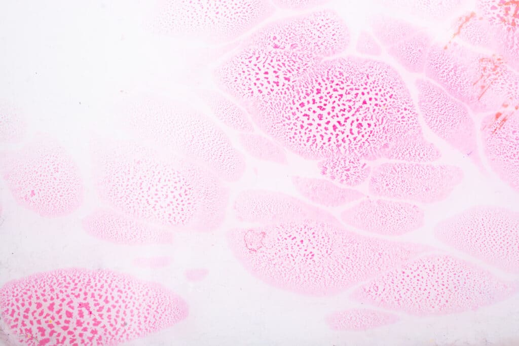 Wysoki poziom leukocytów w cytologii – znaczenie i możliwe przyczyny ...